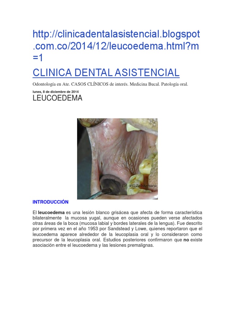 Leucoedema: Patología Oral Común | PDF | Membrana mucosa | Epitelio