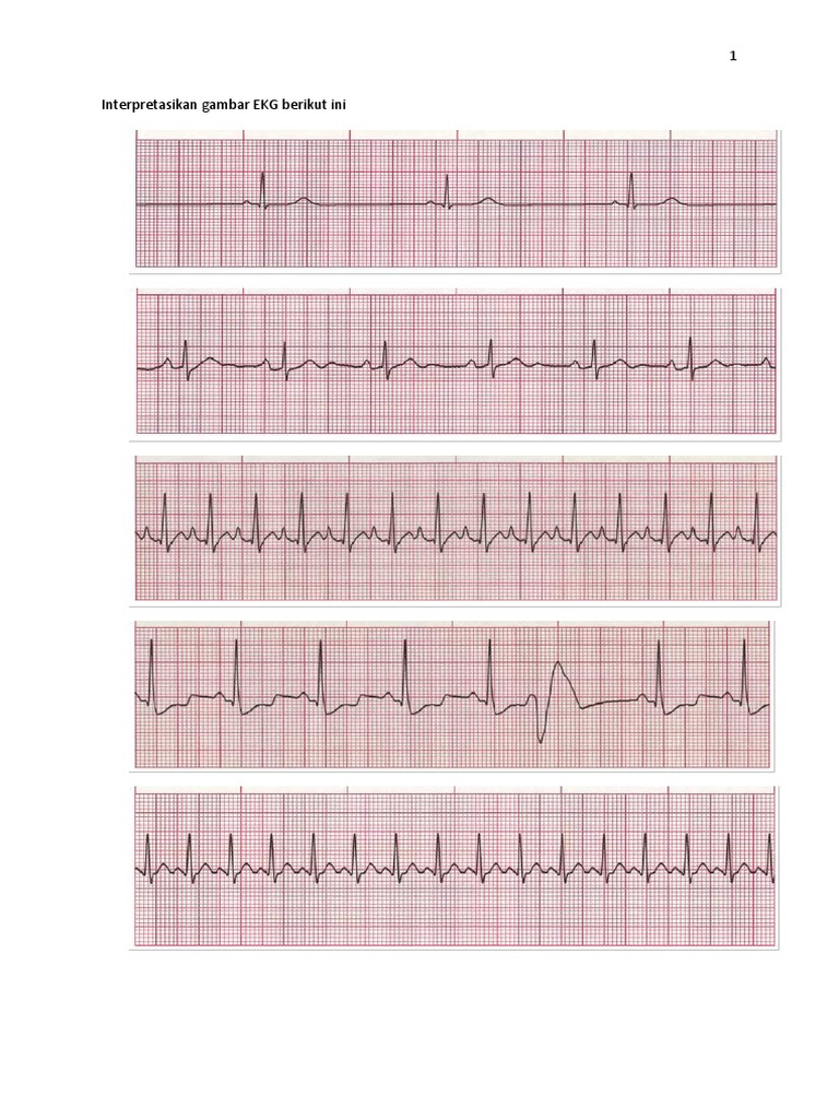 EKG Strip | PDF