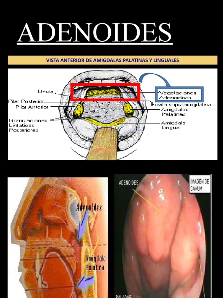 Adenoides Enfermedades Y Trastornos Medicina Clinica