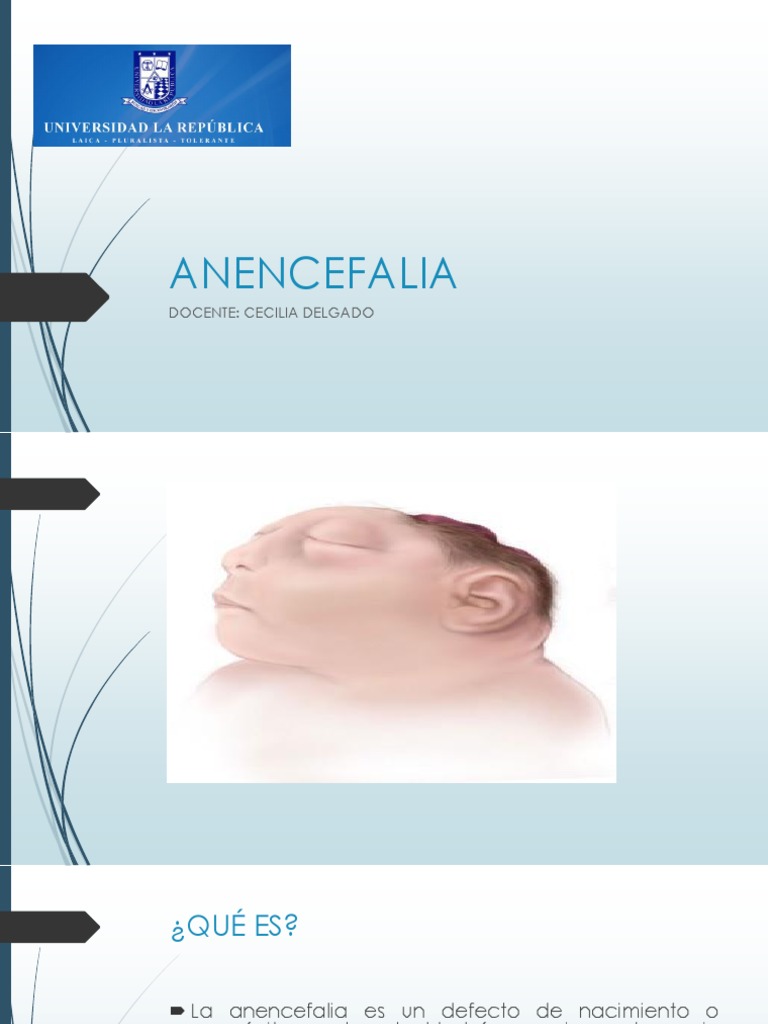 Anencefalia | PDF