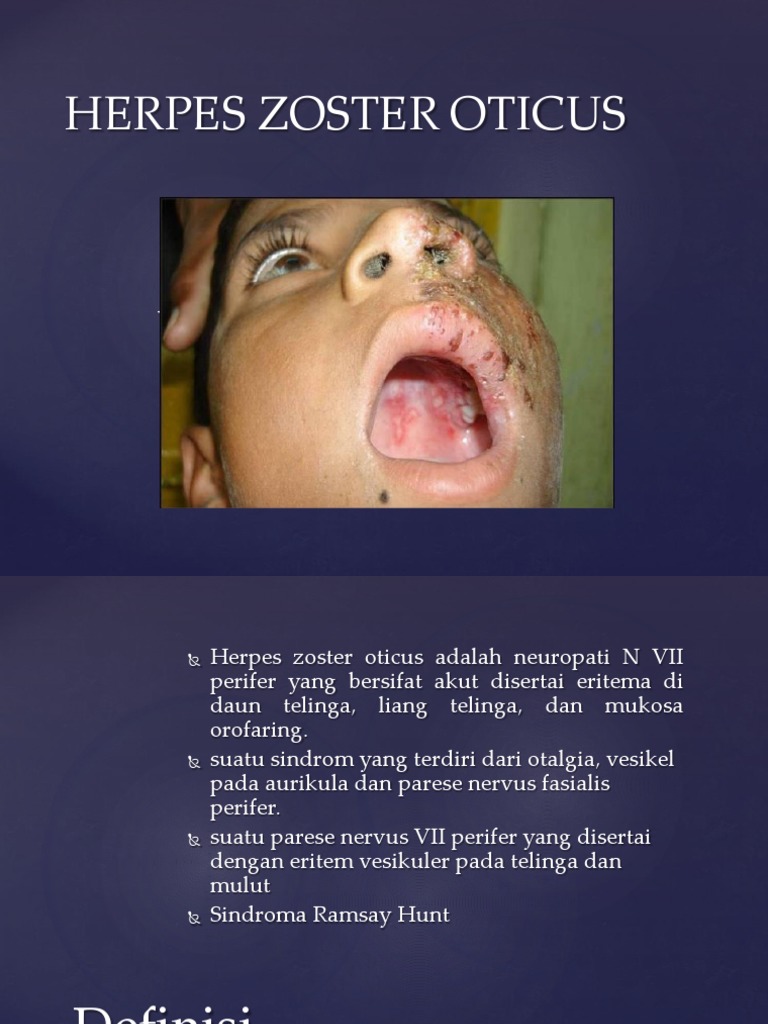 6. HERPES ZOSTER OTICUS.ppt