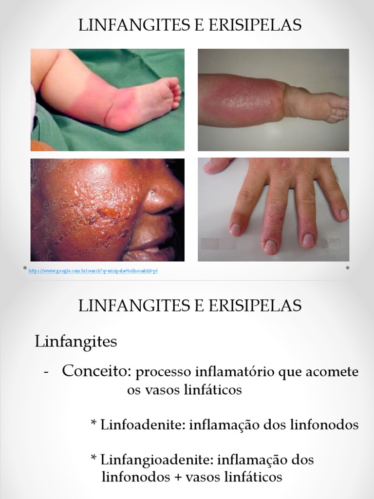 Linfangites e Erisipelas | Sistema Linfático | Linfa