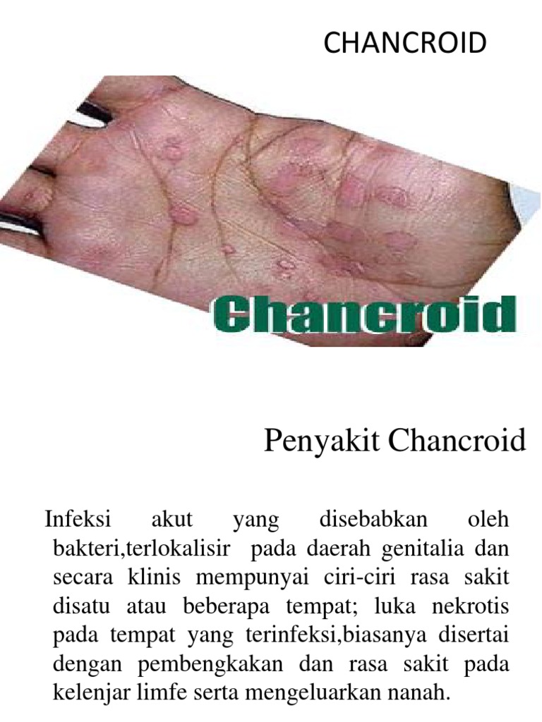 Chancroid | PDF