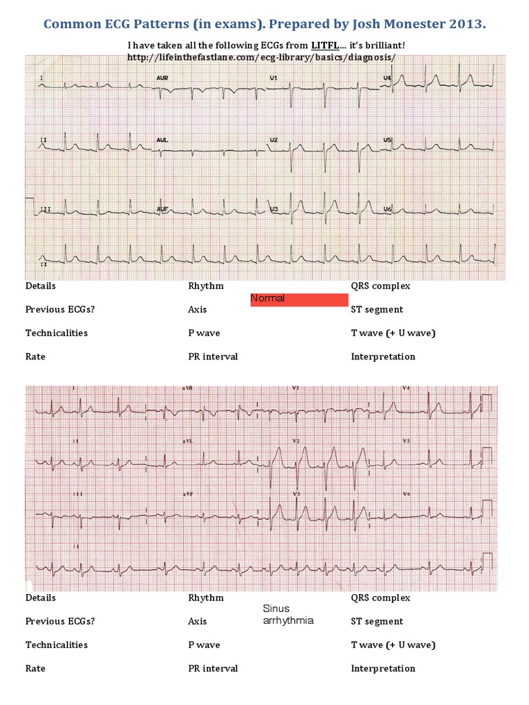 ECG Patterns Worksheet With Annotations | PDF | Electrocardiography ...