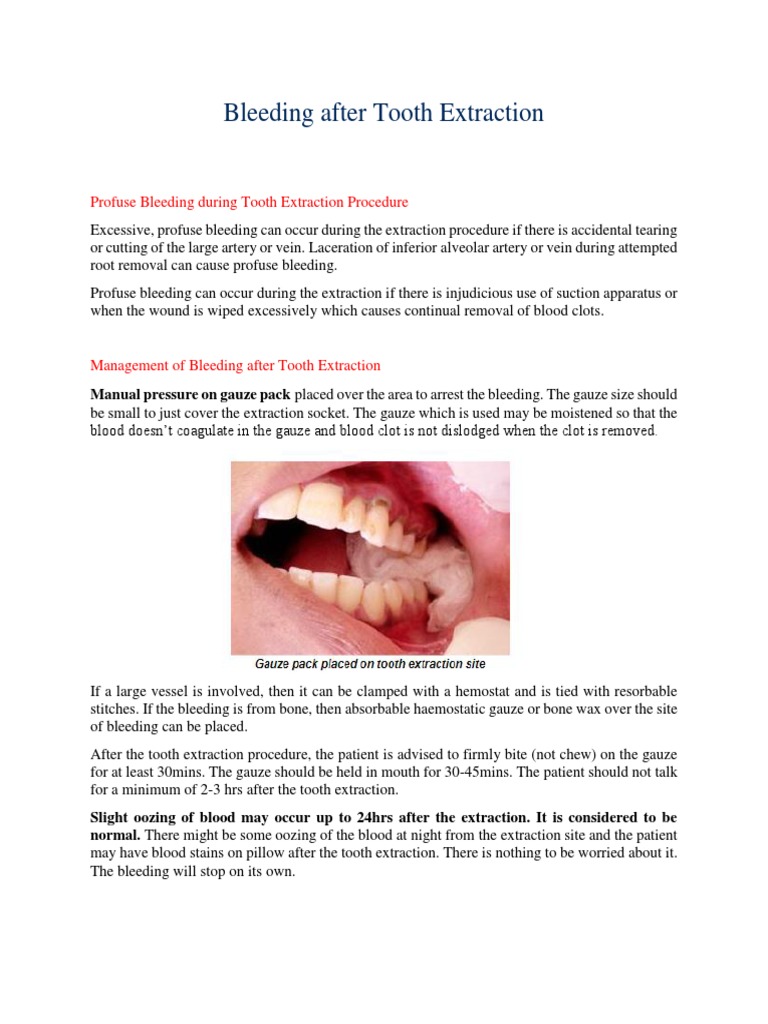 Bleeding After Tooth Extraction | PDF | Bleeding | Animal Anatomy