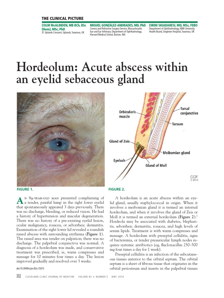 McAlinden Hordeolum PDF | Download Free PDF | Ophthalmology | Clinical Medicine