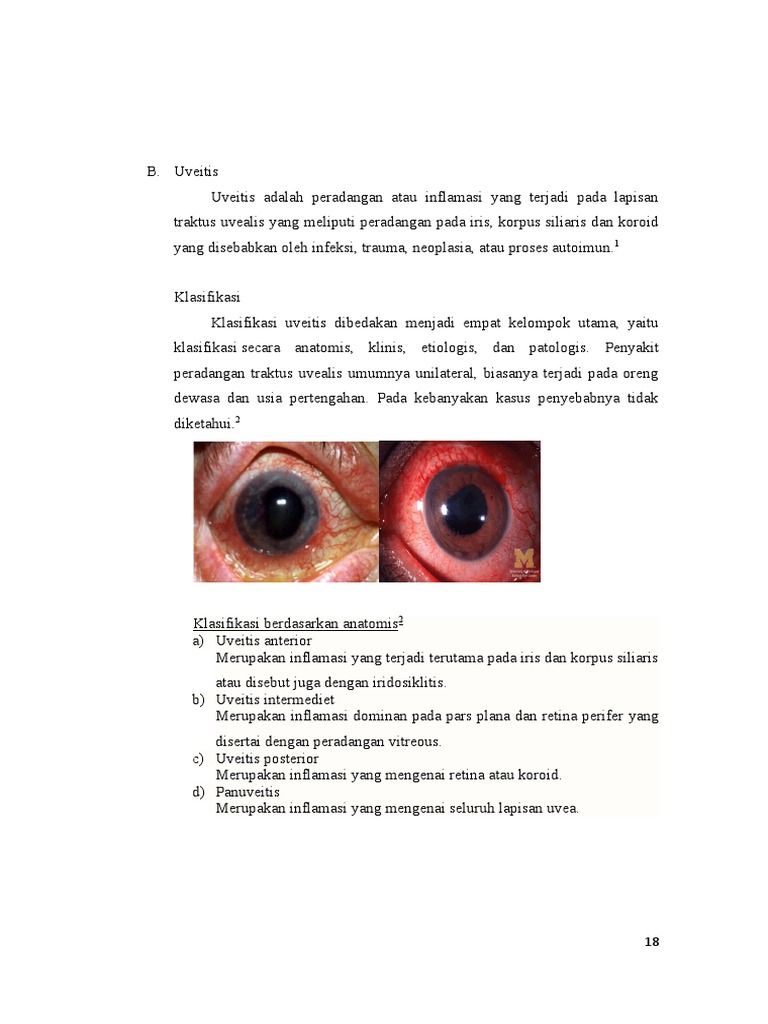Uveitis | PDF