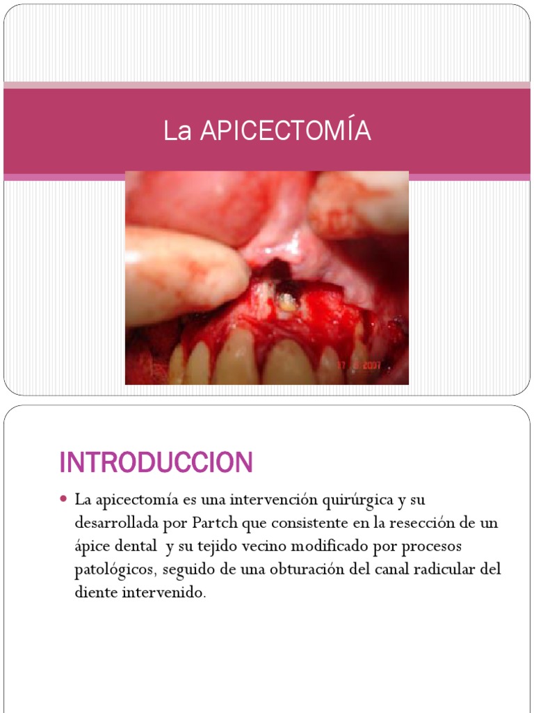 La APICECTOMIA | PDF | Boca | Medicina CLINICA