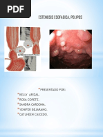 Estenosis Esofágica | PDF | La enfermedad por reflujo gastroesofágico ...