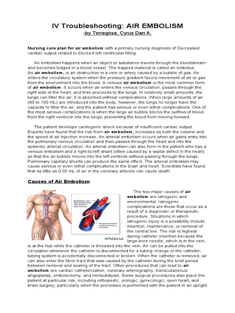 Iv Troubleshooting Air Embolism By Torregosa Cyrus Dan A Pdf Embolism Vein