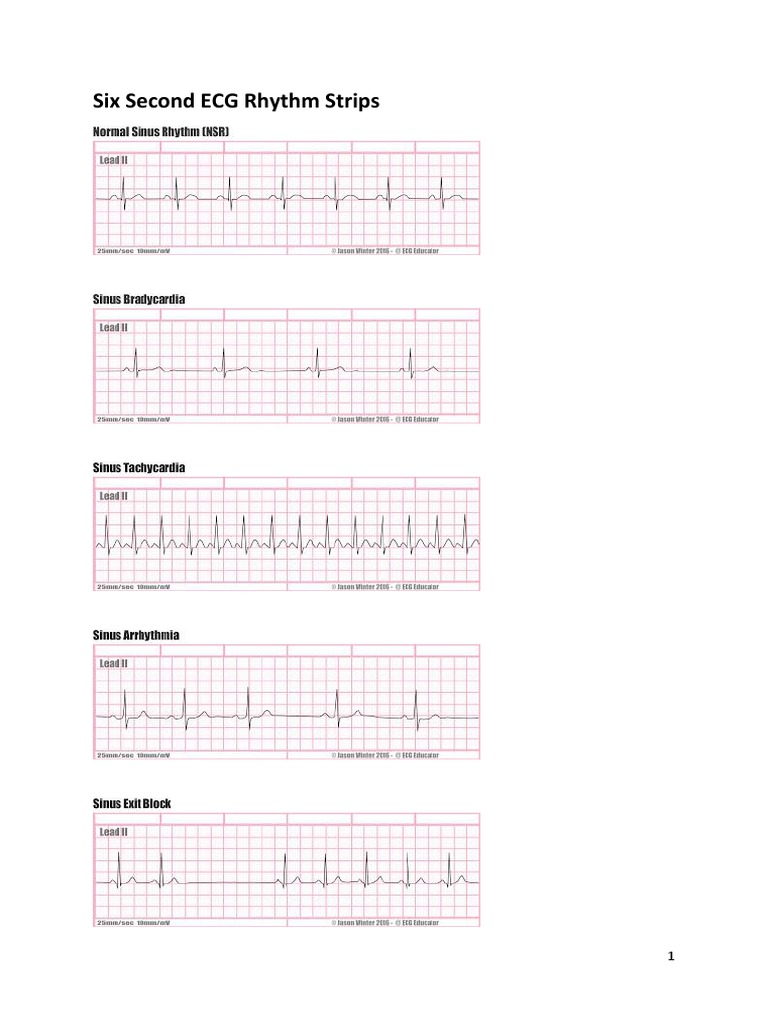 Six Second ECG Rhythm Strips | PDF