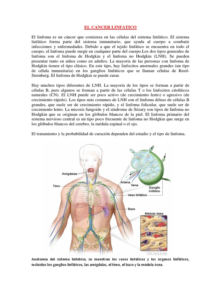 Cancer Linfatico : El Cancer Linfatico Sintomas Tratamiento E ...