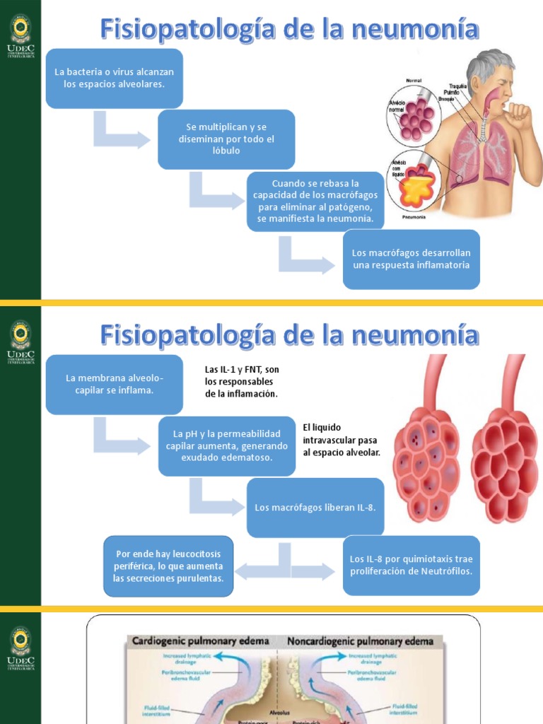 Neumonia | Neumonía | Estadísticas medicas