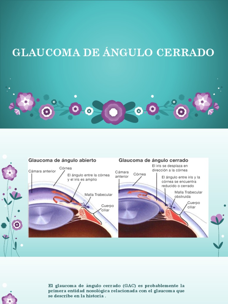 Glaucoma de ángulo cerrado o estrecho | Glaucoma | Ojo humano
