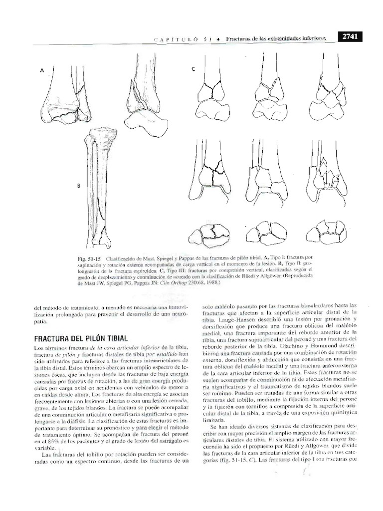 Fractura Del Pilon Tibial | PDF