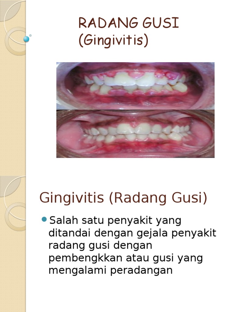Radang Gusi | PDF