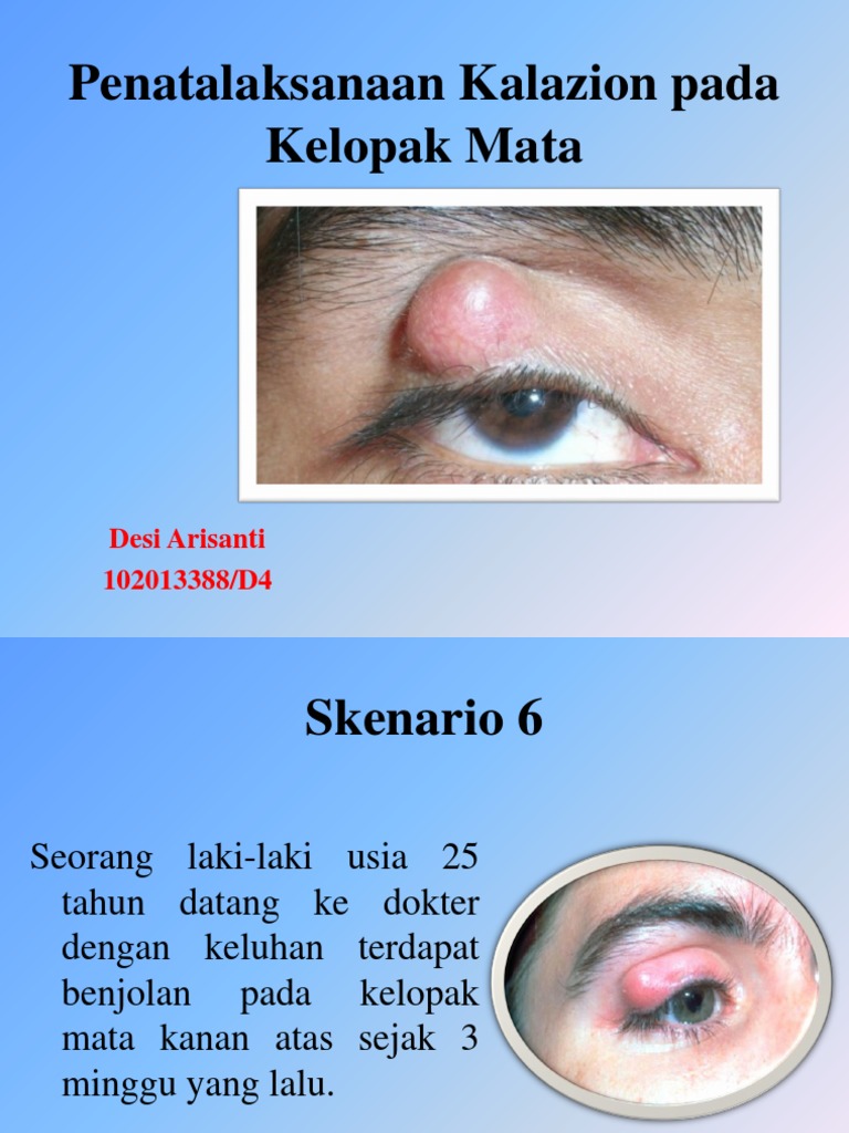 B23 Kalazion | PDF