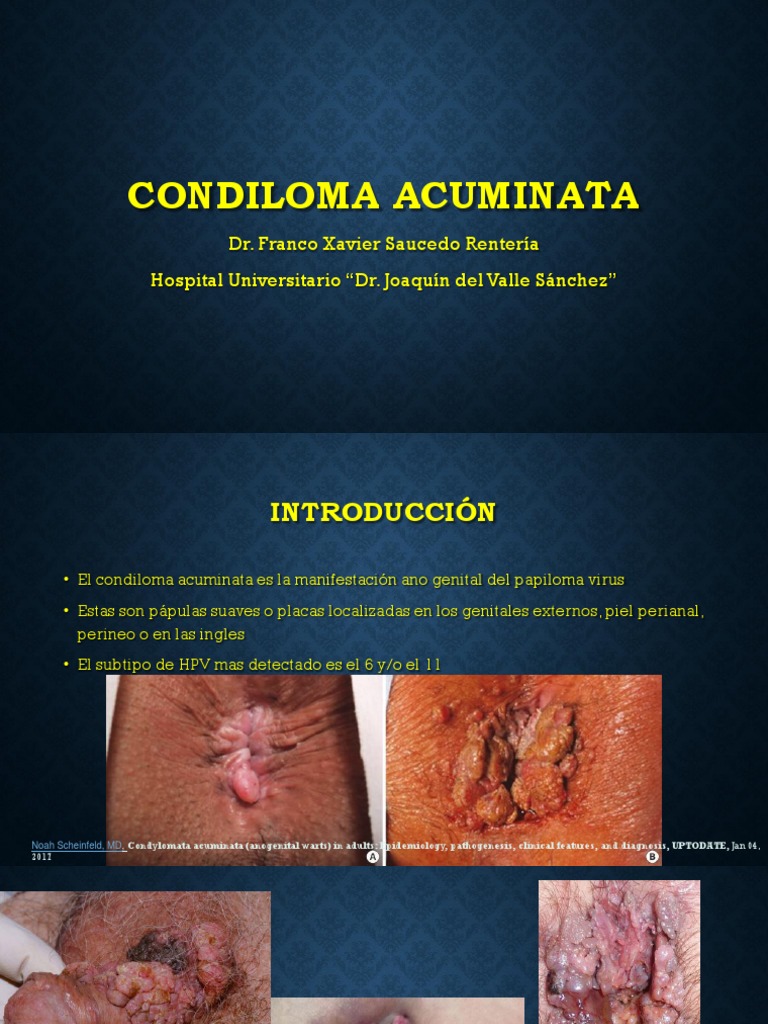 Condiloma Acuminata: Diagnóstico y Tratamiento | PDF | Especialidades ...