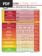 Sgarbossa Criteria - LITFL - ECG Library Diagnosis | PDF ...