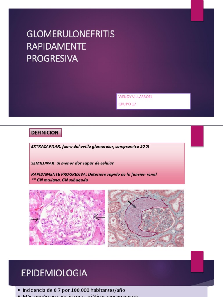 Glomerulonefritis Rapidamente Progresiva | PDF | Riñón | Ciencias de la Salud