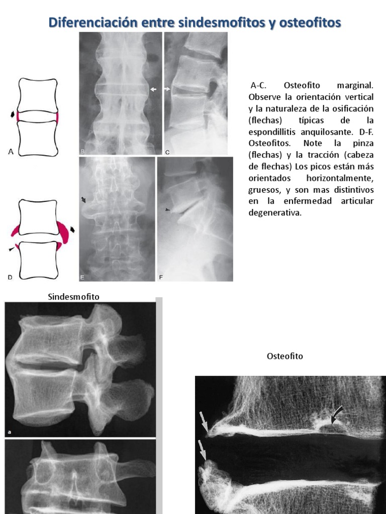 Osteofitos y Sindesmofitos