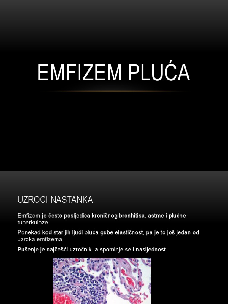 Emfizem Pluća | PDF