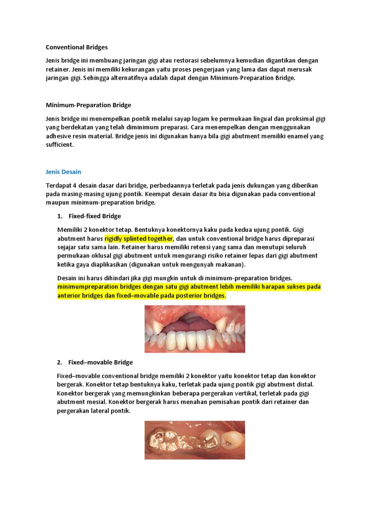 Jenis Desain Bridge Minimum Preparation dan Konvensional | PDF