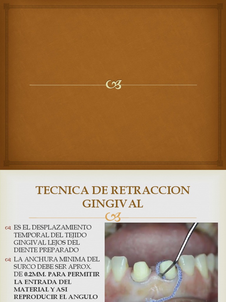 Tecnica de Retraccion Gingival y Tecnicas Retractivas | PDF | Bienestar ...