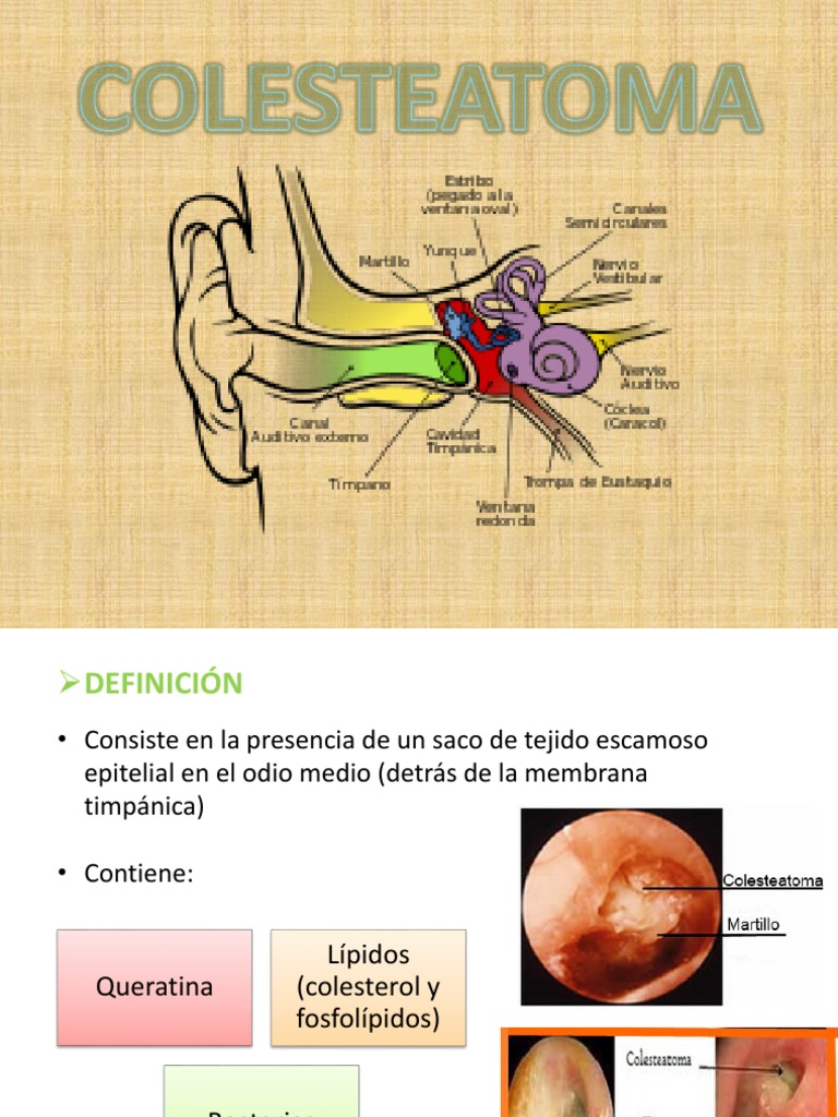 Colesteatoma | PDF | Oído | Anatomía