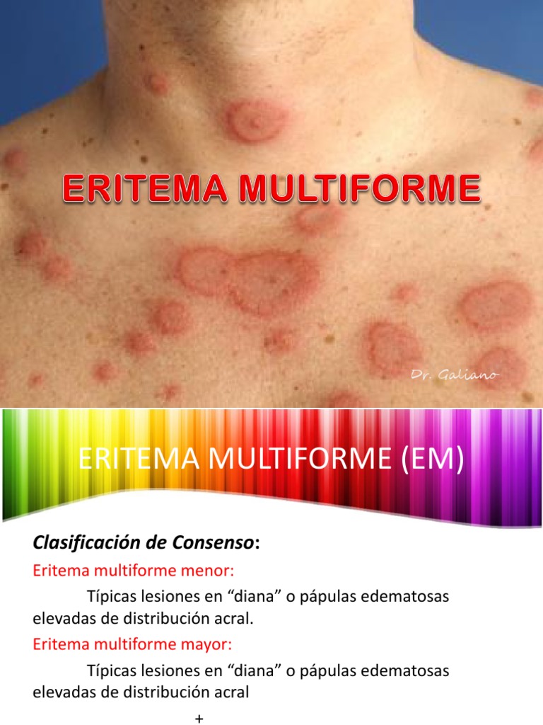 Eritema Multiforme: Clasificación y Manejo | PDF | Especialidades ...