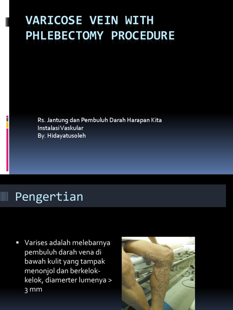 Varicose Vein With Phlebectomy Procedure | PDF | Sains & Matematika
