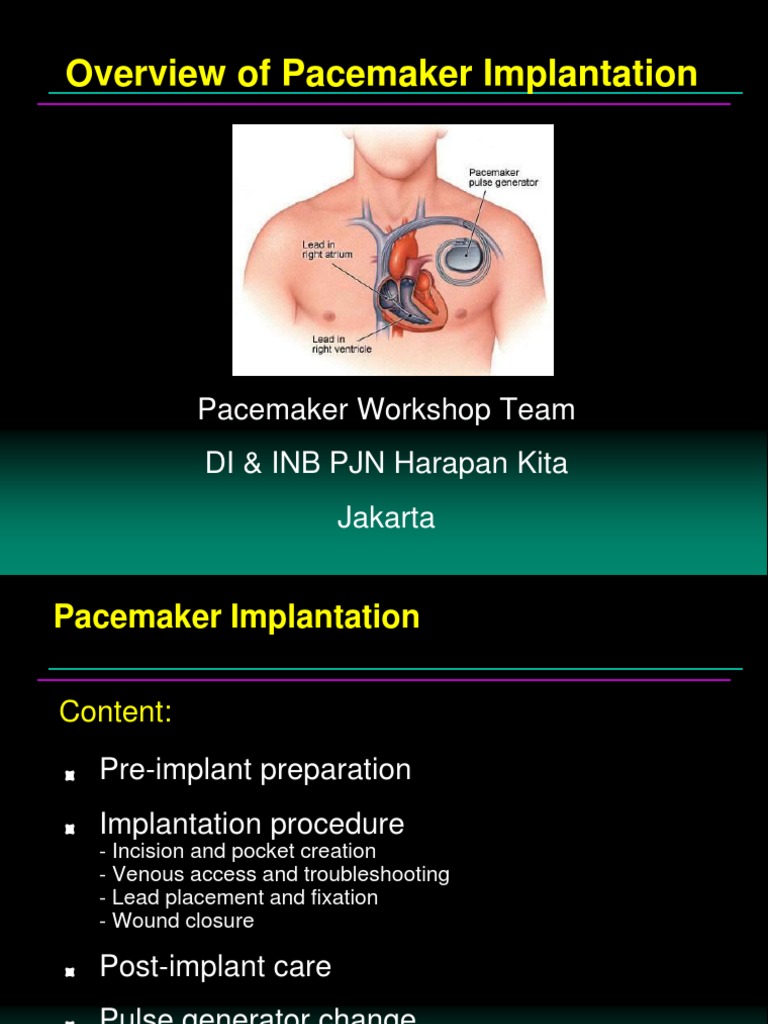 Pacemaker Implant | PDF | Artificial Cardiac Pacemaker | Medical ...