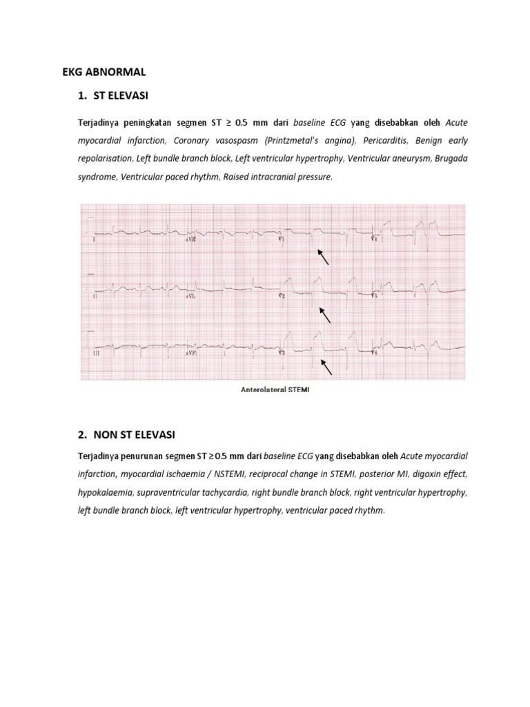 EKG Abnormal | PDF
