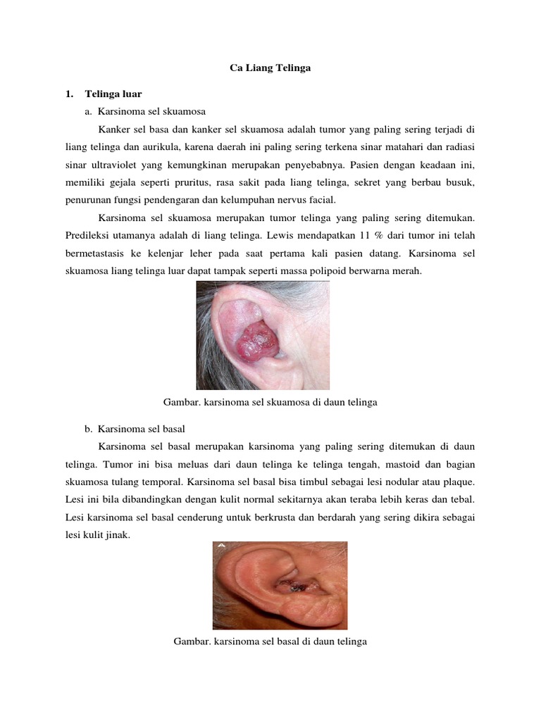 Ca Liang Telinga | PDF