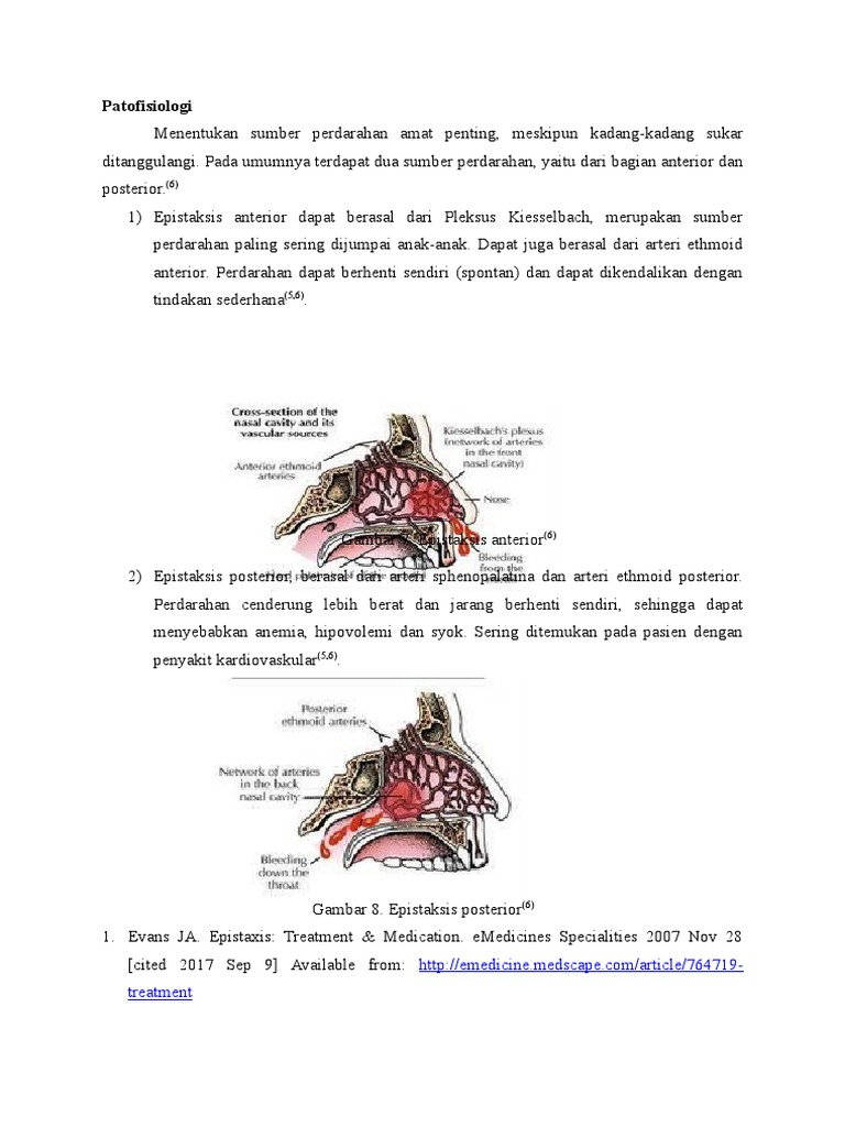Patofisiologi Epistaksis | PDF