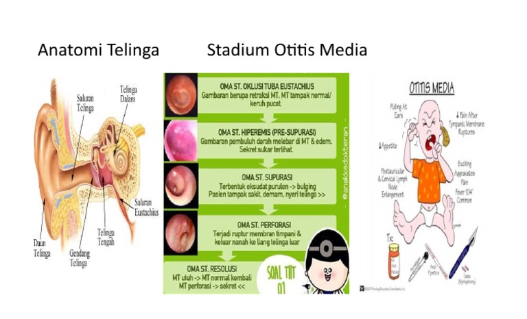 Anatomi TelingaStadium Otitis Media | PDF