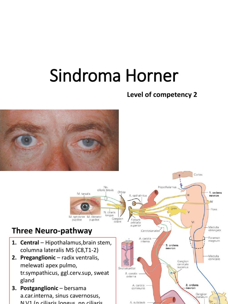 Understanding Horner's Syndrome | PDF