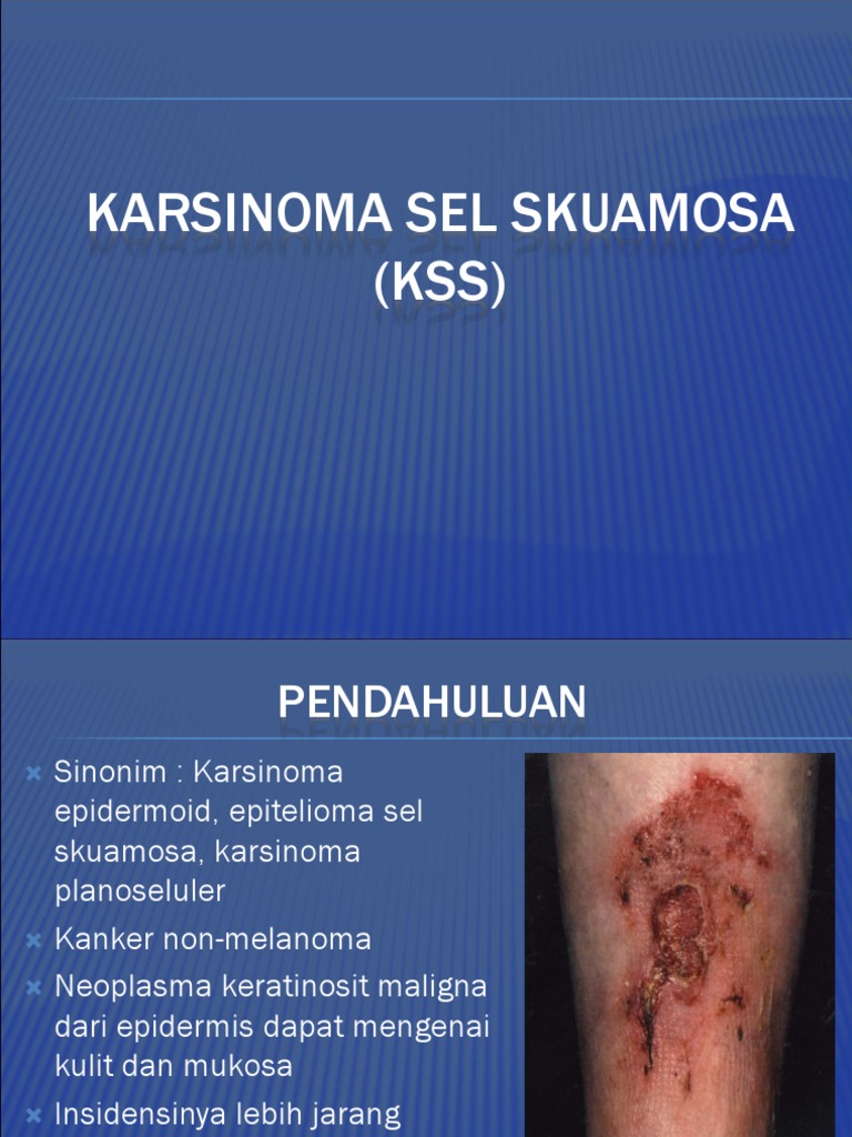 Karsinoma Sel Skuamosa | PDF