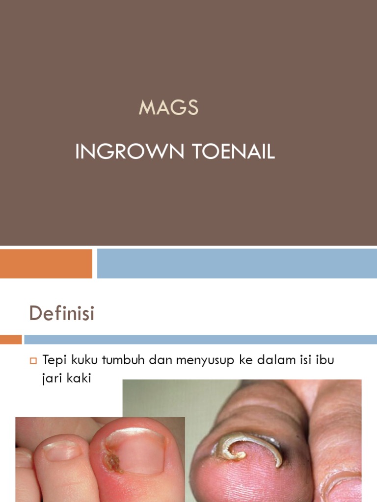Ingrown Toenail | PDF