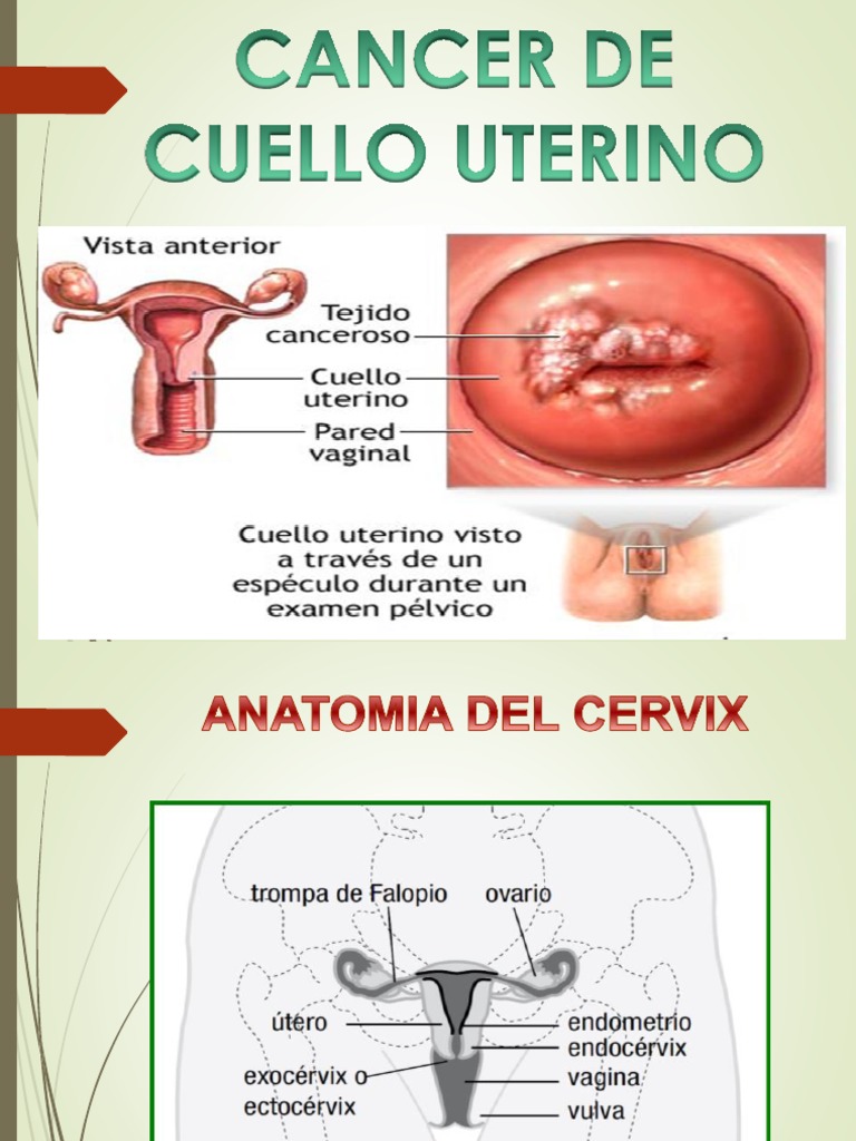 Cancer De Cuello Uterino Alumnos Cáncer De Cuello Uterino Salud Sexual