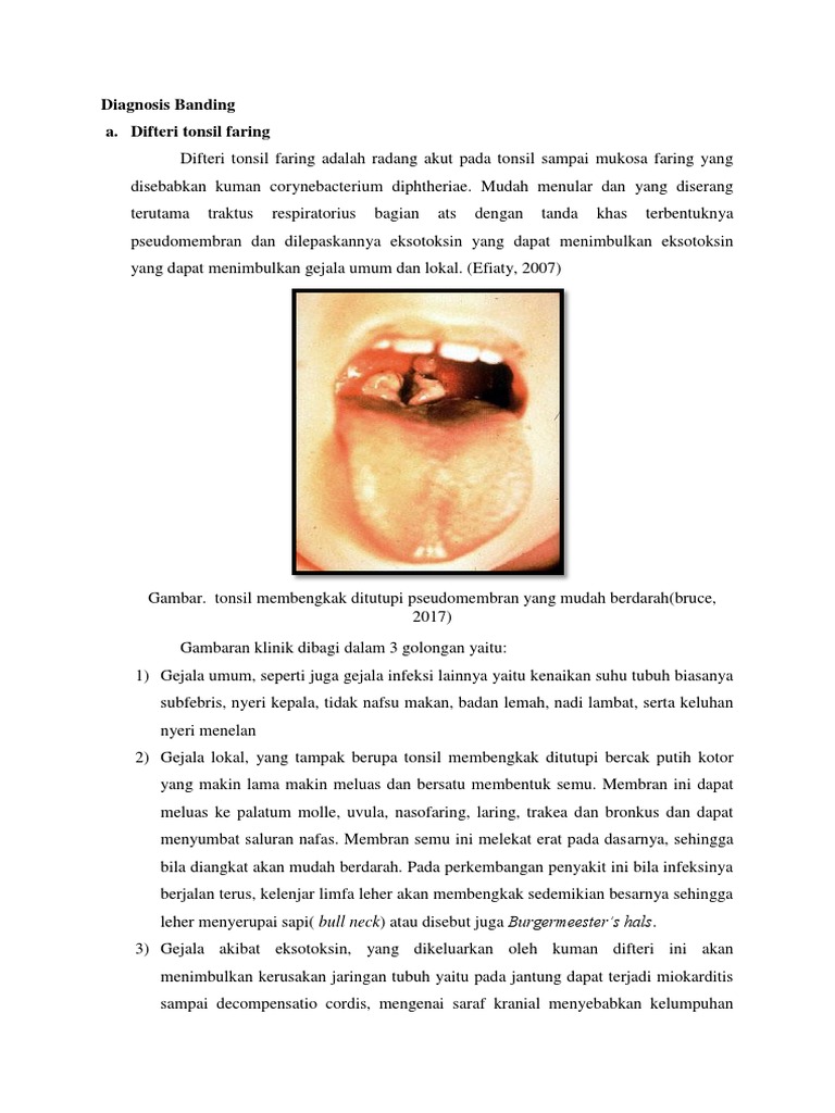 Diagnosis Banding Tonsilitis dan Difteri | PDF