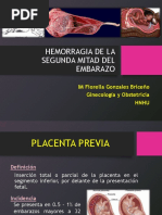 Distocia Funicular: Definición y Evaluación | PDF | Parto | Feto