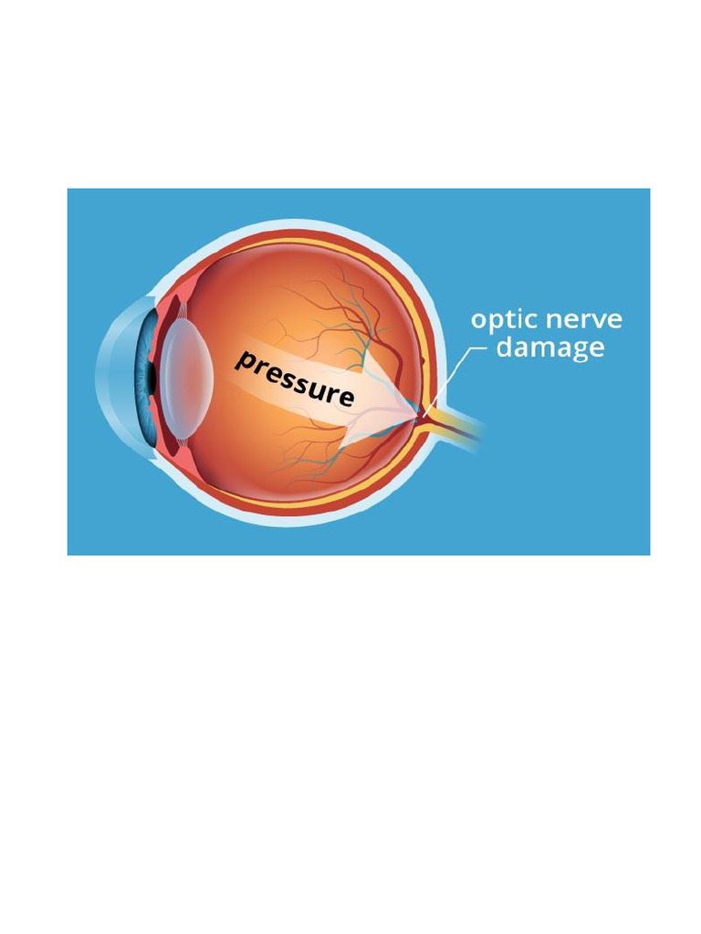 Glaucoma Chapter | PDF | Glaucoma | Cornea