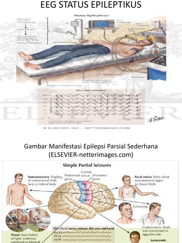 EEG Status Epileptikus DAN Gambar Beserta EEG Epilepsi | PDF
