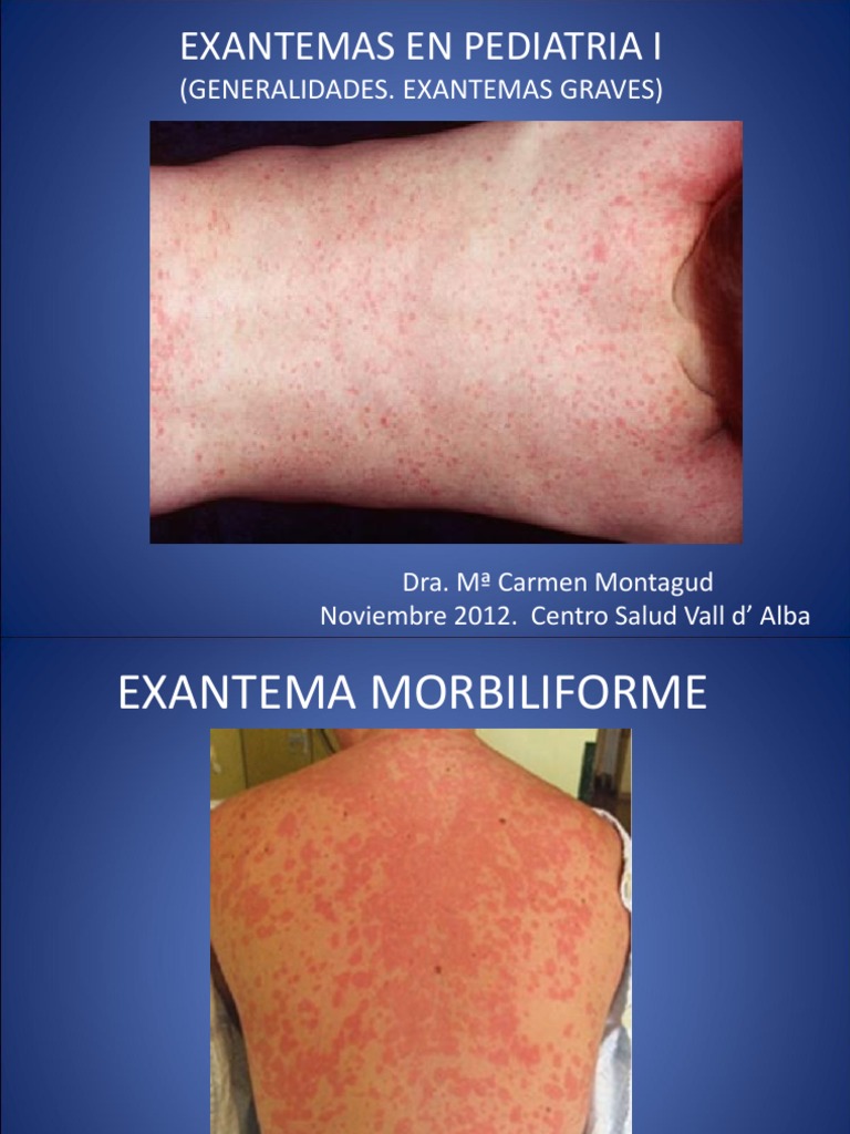 Exantemasenpediatriaigeneralidadesyexantemasgraves | PDF | Condiciones ...