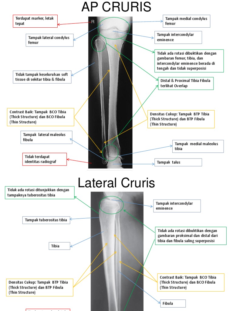 Cruris (Tibia & Fibula) | PDF
