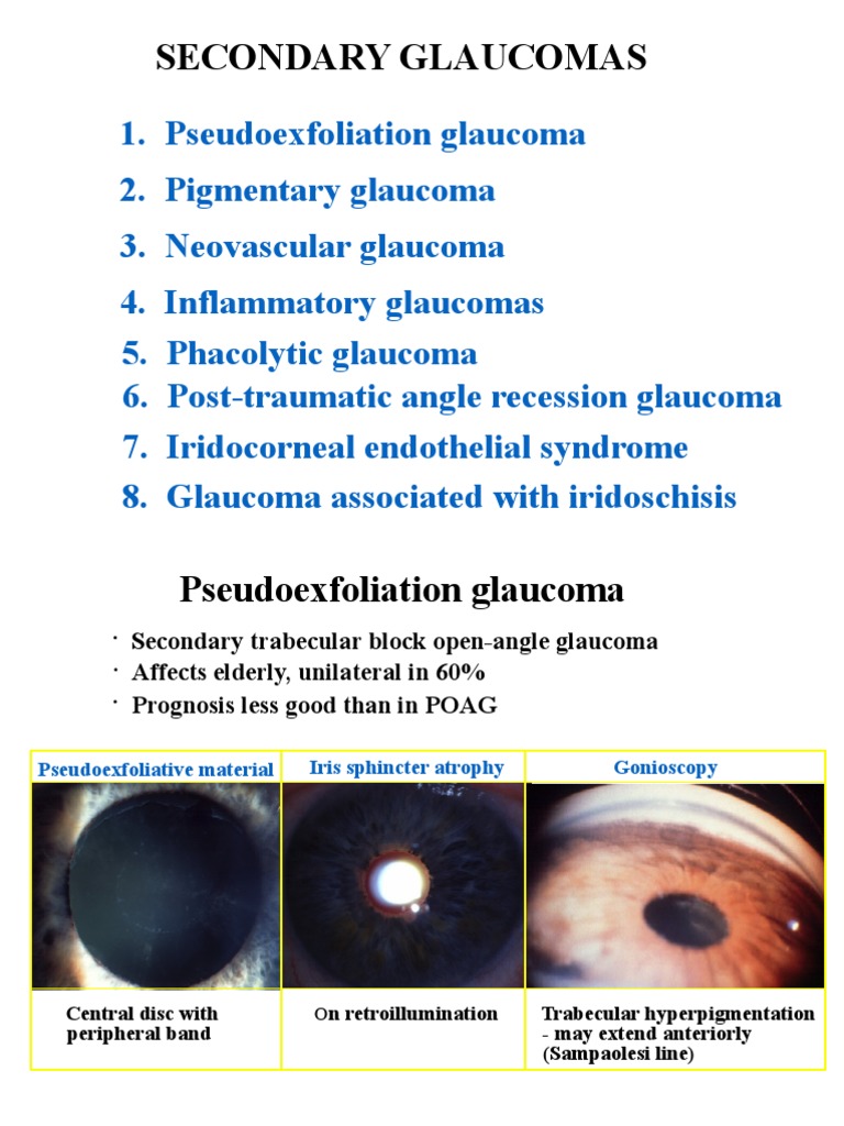 30secondary Glaucomas | PDF | Glaucoma | Diseases Of The Eye And Adnexa