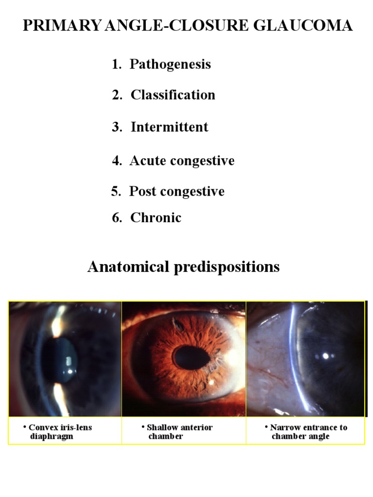 29primary AngleClosure Glau | PDF | Glaucoma | Ophthalmology