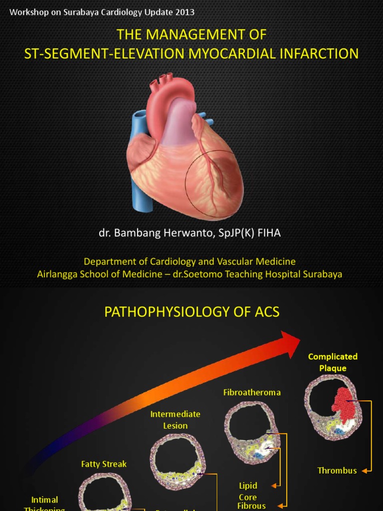 ACS-STEMI Management (Dr. Bambang Herwanto, SPJP) | PDF | Percutaneous ...