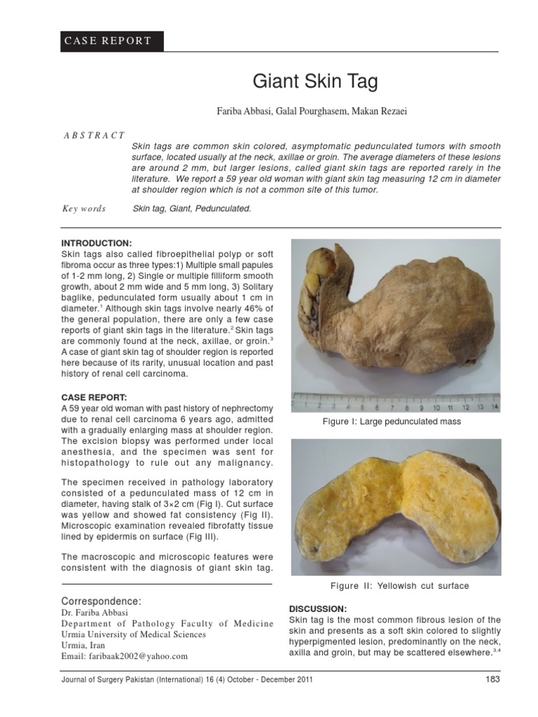 Giant Skin Tag | PDF | Neoplasms | Health Sciences